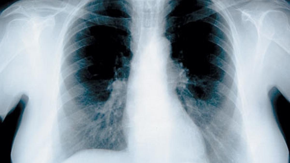 Cancerul pulmonar nu se vede la radiografie