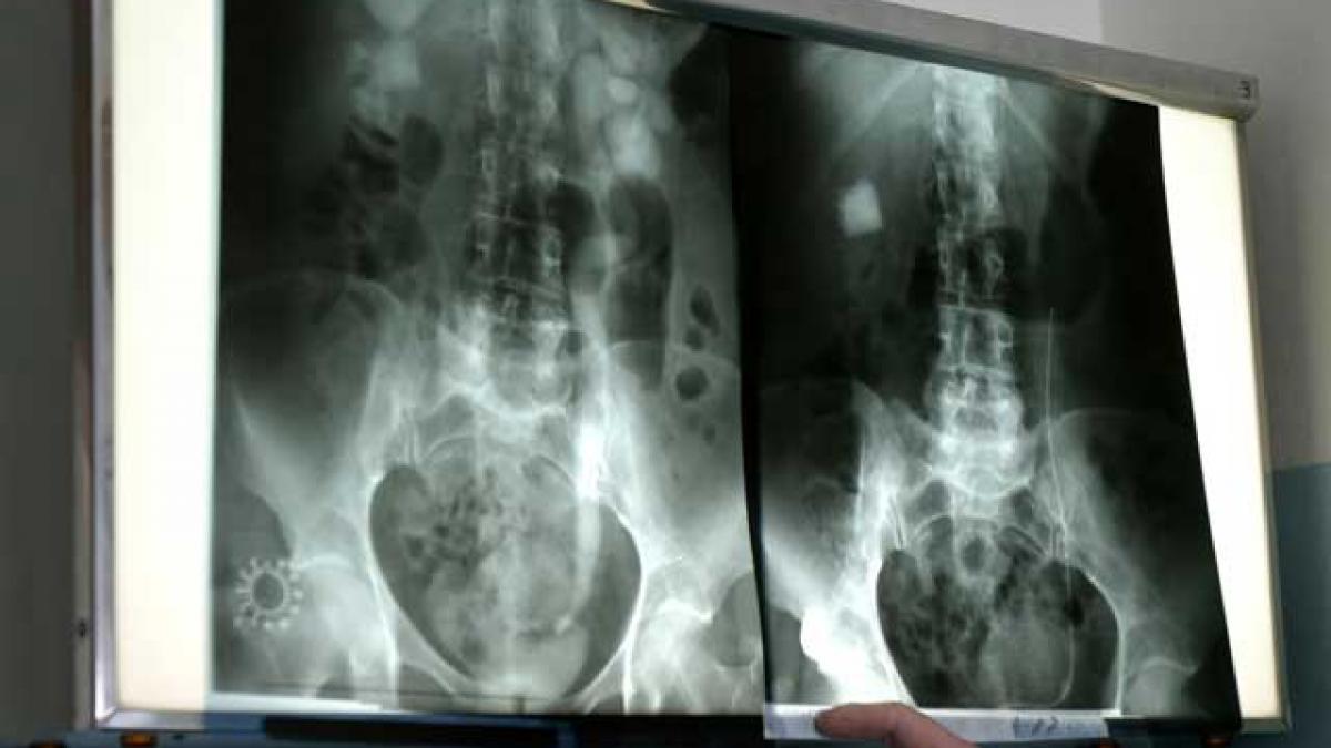 Ce este urografia intravenoasa