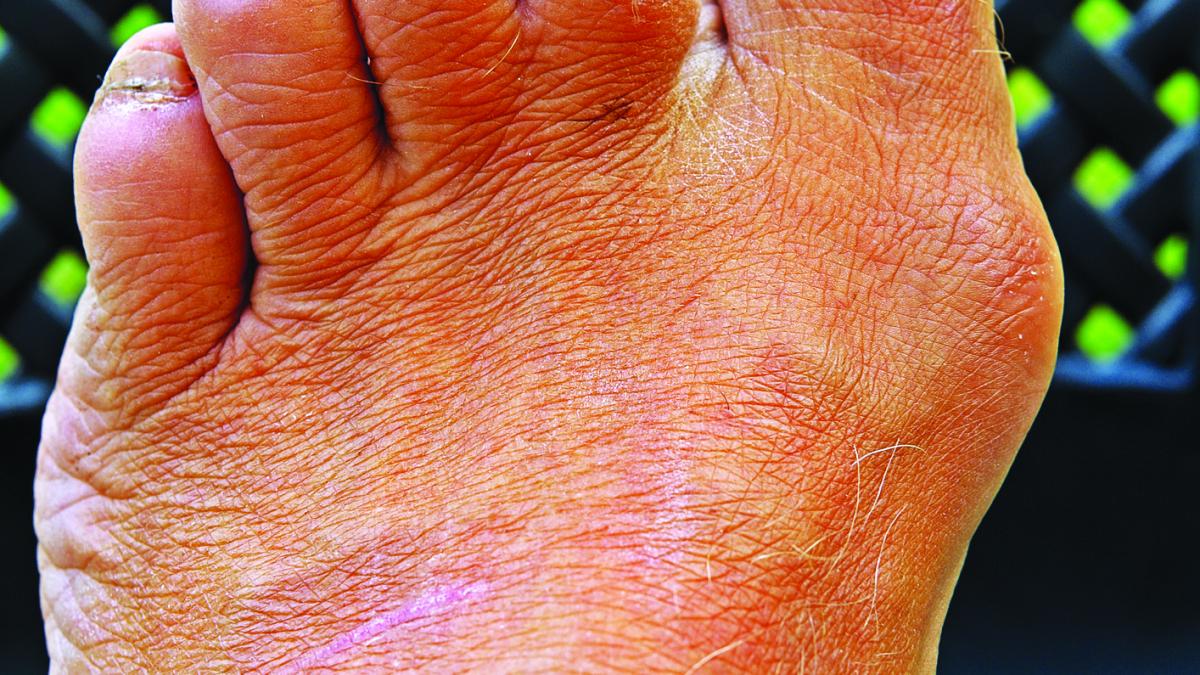 Semnal de alarmă: deformările și durerile de la degetele mari ale ...