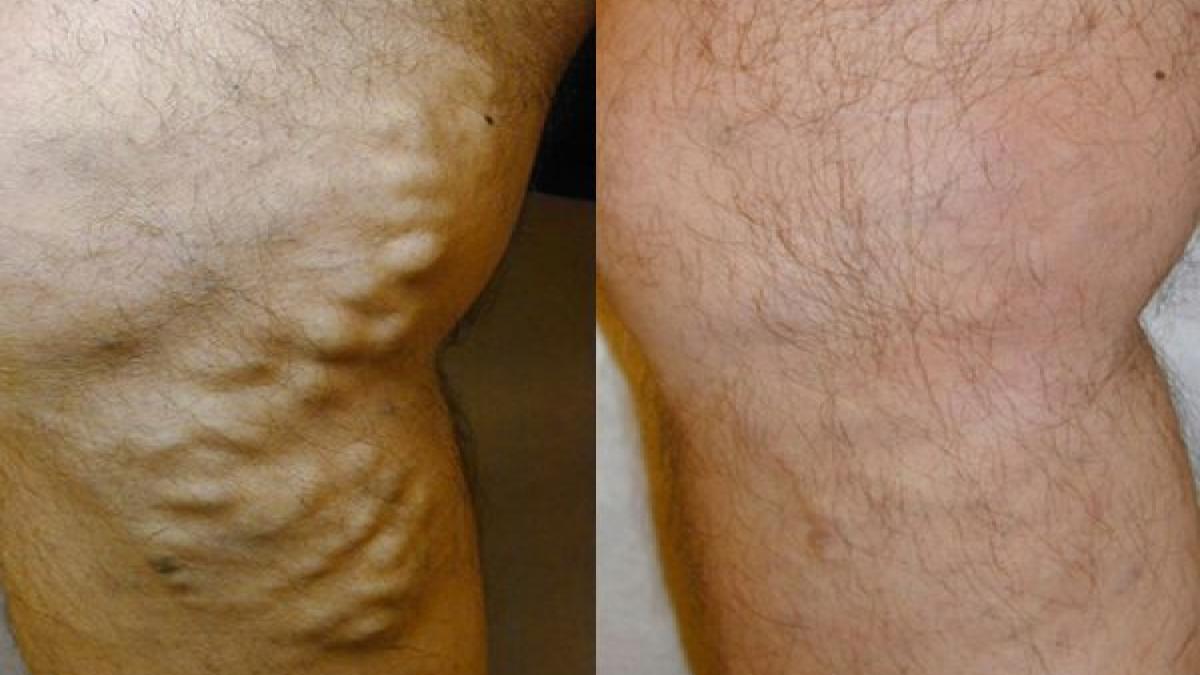 Varicele: Cauze, simptome și tratament