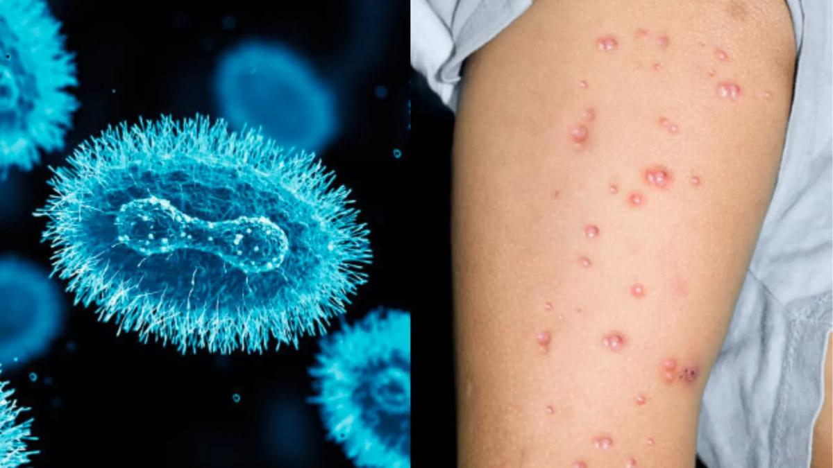 Varianta mortală a variolei maimuței a ajuns în Europa. ECDC trage un ...