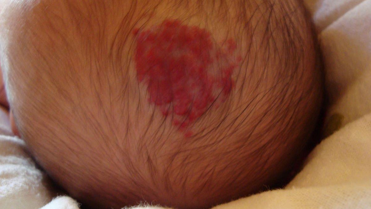 Baby Bumps and Birthmarks: Uncovering the Truth About Hemangiomas in ...