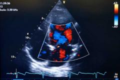 Ce este histerosalpingografia